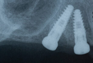 Angulated Implant Placement in the Posterior Maxilla to Avoid Sinus ...