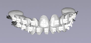 Faster and More Predictable Treatment with 100% Custom 3D-Printed ...