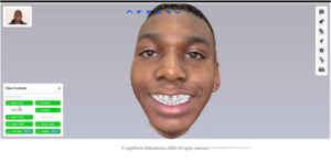 Faster and More Predictable Treatment with 100% Custom 3D-Printed ...