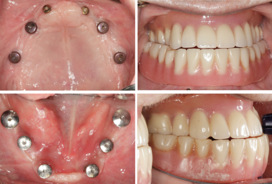 1 - Temporary dentures - upper denture is under-extended to maximize ...