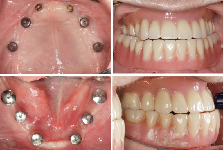 Rehabilitation of Both Failing Implants and Remaining Dentition with ...