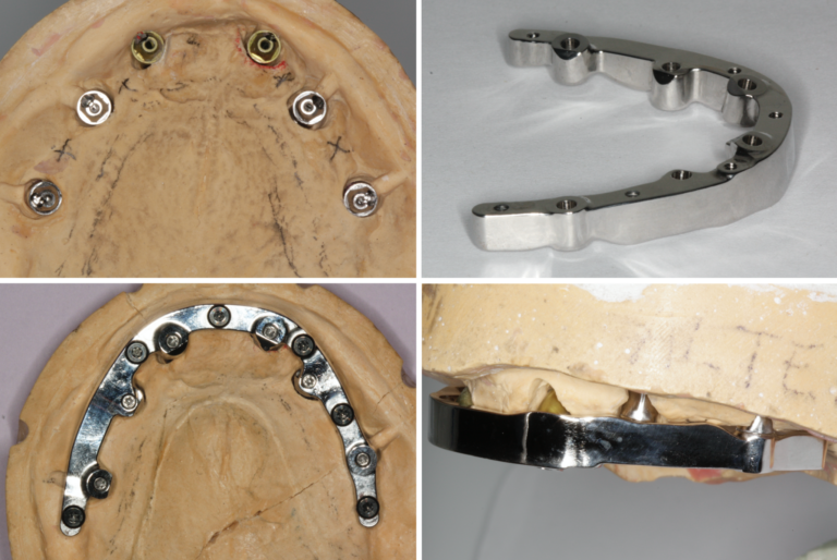 Rehabilitation of Both Failing Implants and Remaining Dentition with ...