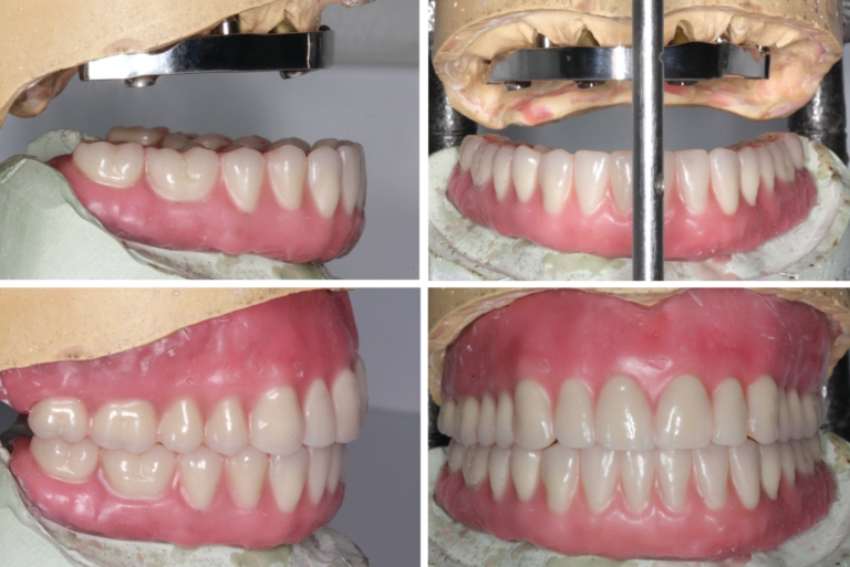 Rehabilitation of Both Failing Implants and Remaining Dentition with ...