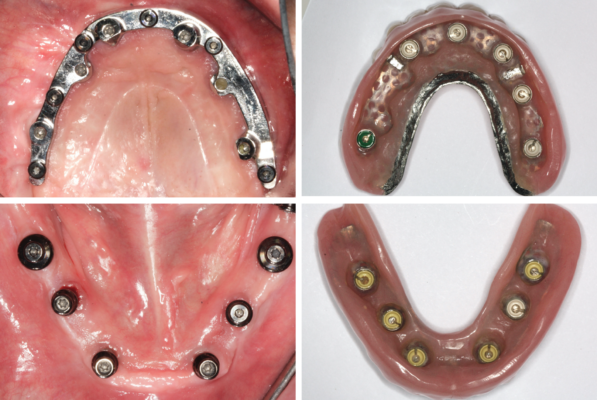 7 - Intra-oral view - The inserted maxillary bar has achieved parallelism of the Straumann ...