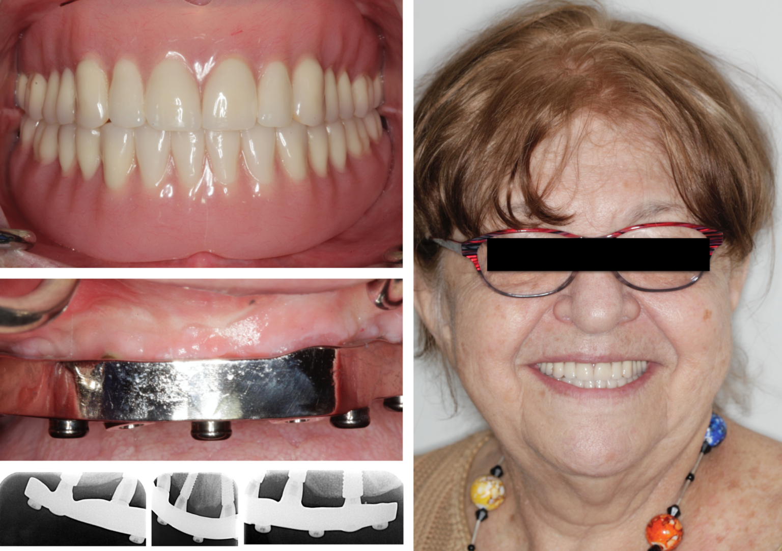 Rehabilitation of Both Failing Implants and Remaining Dentition with ...
