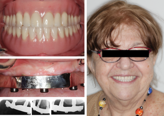 Rehabilitation of Both Failing Implants and Remaining Dentition with ...