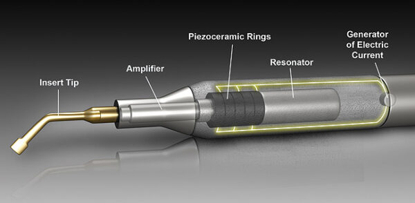 Removal of Impacted Third Molars: High Speed Bur or Piezosurgery?