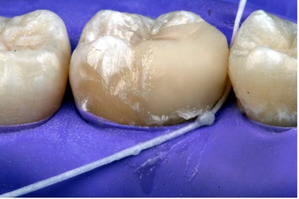 A New Tool for Cleaning Excess Resin Cement - Oral Health Group