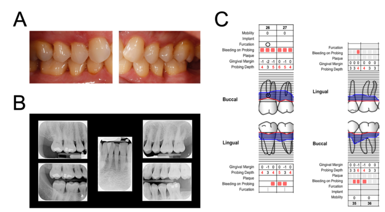 A Novel Simplified Stepwise Approach to Diagnosing Periodontal Diseases ...