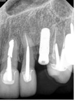 Prognosis of Implants in Previously Failed Surgical Sites - Oral Health ...