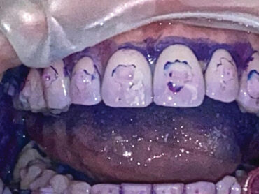 Guided Biofilm Therapy: Why and How of Oral Biofilm Management