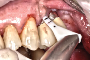 Guided Biofilm Therapy: Why and How of Oral Biofilm Management
