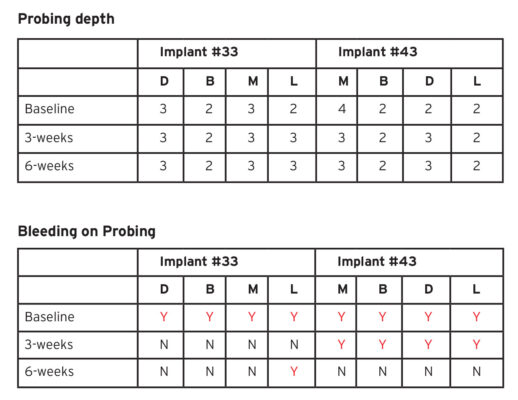 Dental Implant Self-Care: Implant Supported Dentures (Second in a ...