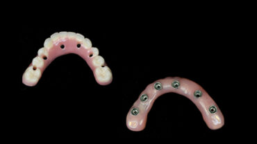 An Alternative Prosthetic Design for Lower Full-Arch Implant Restorations