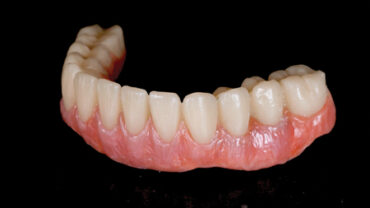 An Alternative Prosthetic Design for Lower Full-Arch Implant Restorations