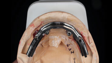 An Alternative Prosthetic Design for Lower Full-Arch Implant Restorations
