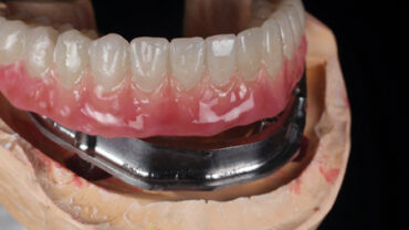 An Alternative Prosthetic Design for Lower Full-Arch Implant Restorations