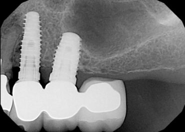 Peri-implantitis: How to Reduce Risk and Manage Implant Failure?