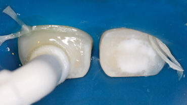 Revolutionizing Minimally Invasive Dentistry with Resin Infiltration