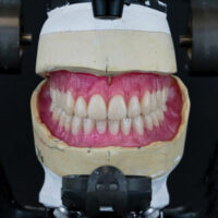 Lingualized Occlusion: An Occlusal Scheme for Complete Dentures in ...