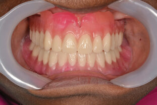 Lingualized Occlusion: An Occlusal Scheme for Complete Dentures in ...