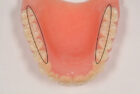 Lingualized Occlusion: An Occlusal Scheme for Complete Dentures in ...
