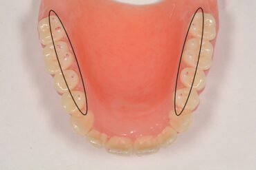 Lingualized Occlusion: An Occlusal Scheme for Complete Dentures in ...