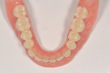 Lingualized Occlusion: An Occlusal Scheme for Complete Dentures in ...