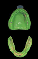 Lingualized Occlusion: An Occlusal Scheme for Complete Dentures in ...