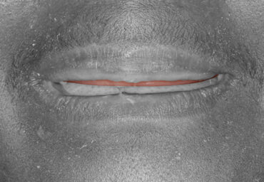 Lingualized Occlusion: An Occlusal Scheme for Complete Dentures in ...