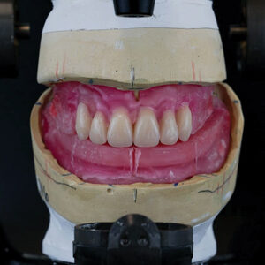 Kumar Fig 9 Anterior Set Up Oral Health Group