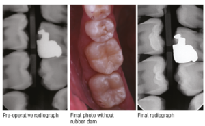 Restoring Class 1 Decay - A Case Study - Oral Health Group
