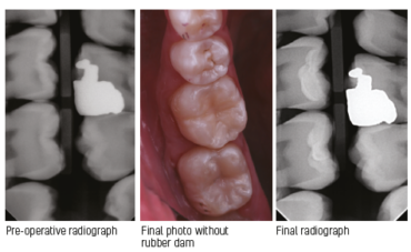 Restoring Class 1 Decay - A Case Study - Oral Health Group