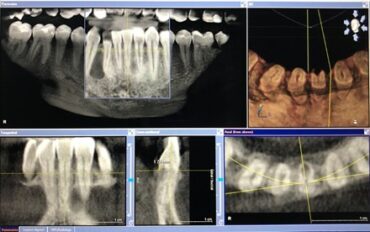 Invasive Cervical Resorption: A Dental Pandemic or an Auto-immune ...