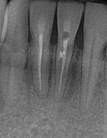Invasive Cervical Resorption: A Dental Pandemic or an Auto-immune ...