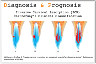 Invasive Cervical Resorption: A Dental Pandemic or an Auto-immune ...