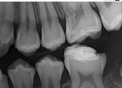 Invasive Cervical Resorption: A Dental Pandemic or an Auto-immune ...