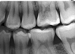 Invasive Cervical Resorption: A Dental Pandemic or an Auto-immune ...