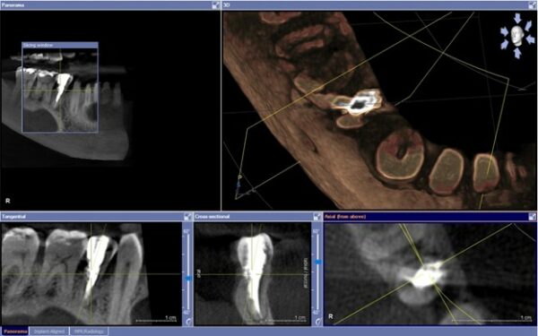 Invasive Cervical Resorption: A Dental Pandemic or an Auto-immune ...