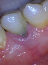 Invasive Cervical Resorption: A Dental Pandemic or an Auto-immune ...