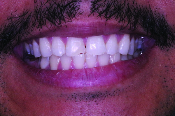 Successful and Efficient Complete Restoration of an Abrasion Dentition ...