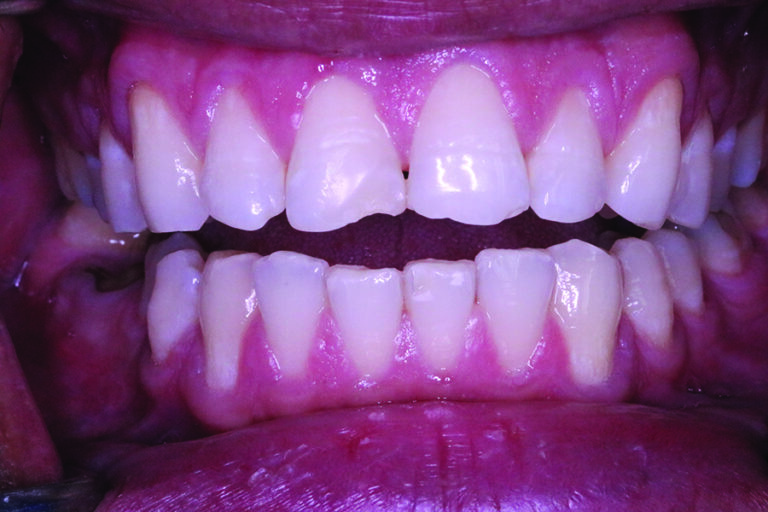 Successful and Efficient Complete Restoration of an Abrasion Dentition ...
