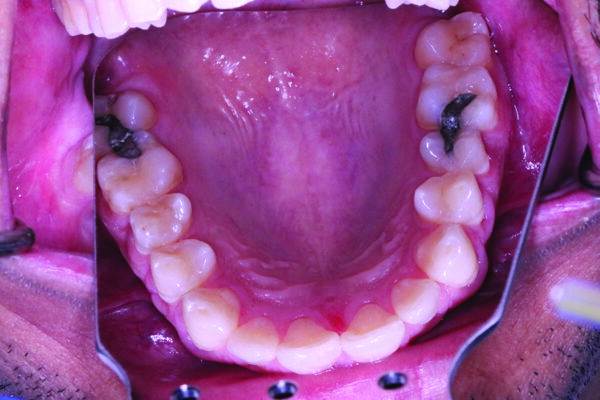 Successful and Efficient Complete Restoration of an Abrasion Dentition ...