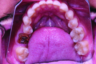 Successful and Efficient Complete Restoration of an Abrasion Dentition ...