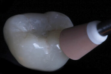 Polishing High-Strength Ceramics Such as Zirconia and Lithium ...