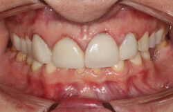 Treatment Decisions for Missing Maxillary Laterals Based on Case Types ...