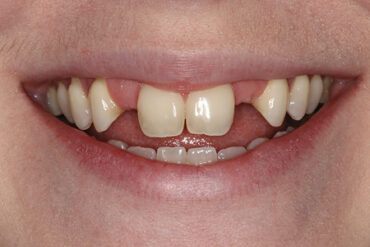 Treatment Decisions for Missing Maxillary Laterals Based on Case Types ...