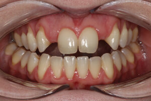 Treatment Decisions for Missing Maxillary Laterals Based on Case Types ...