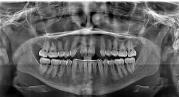 Treatment Decisions for Missing Maxillary Laterals Based on Case Types ...