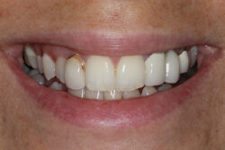 Treatment Decisions for Missing Maxillary Laterals Based on Case Types ...